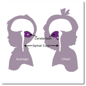 Myriah’s Chiari Malformation Story - Bread & With It